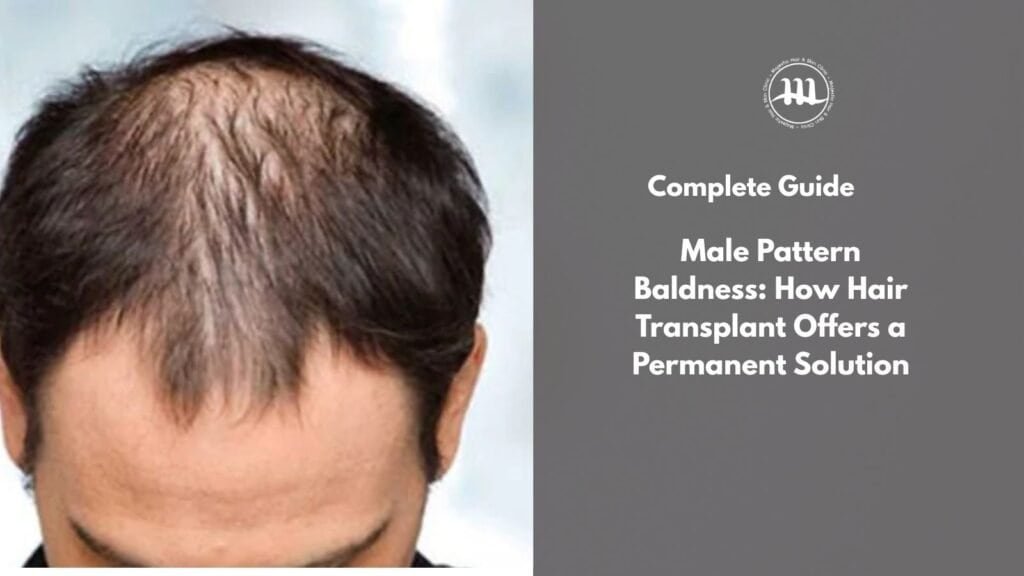 Male Pattern Baldness: Permanent Cure With Hair Transplant