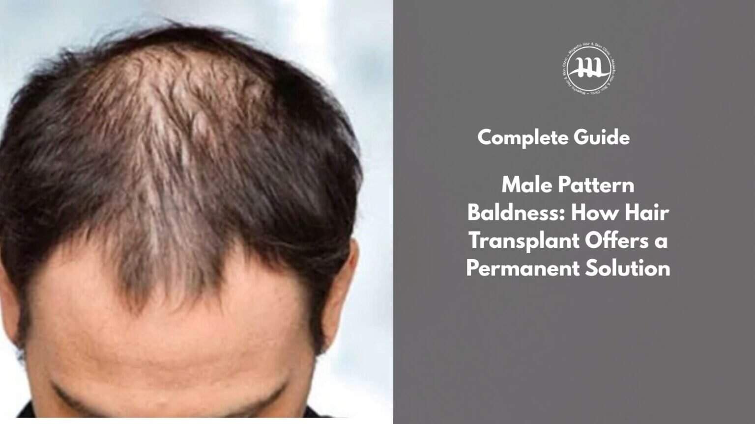 Male Pattern Baldness: Permanent Cure With Hair Transplant