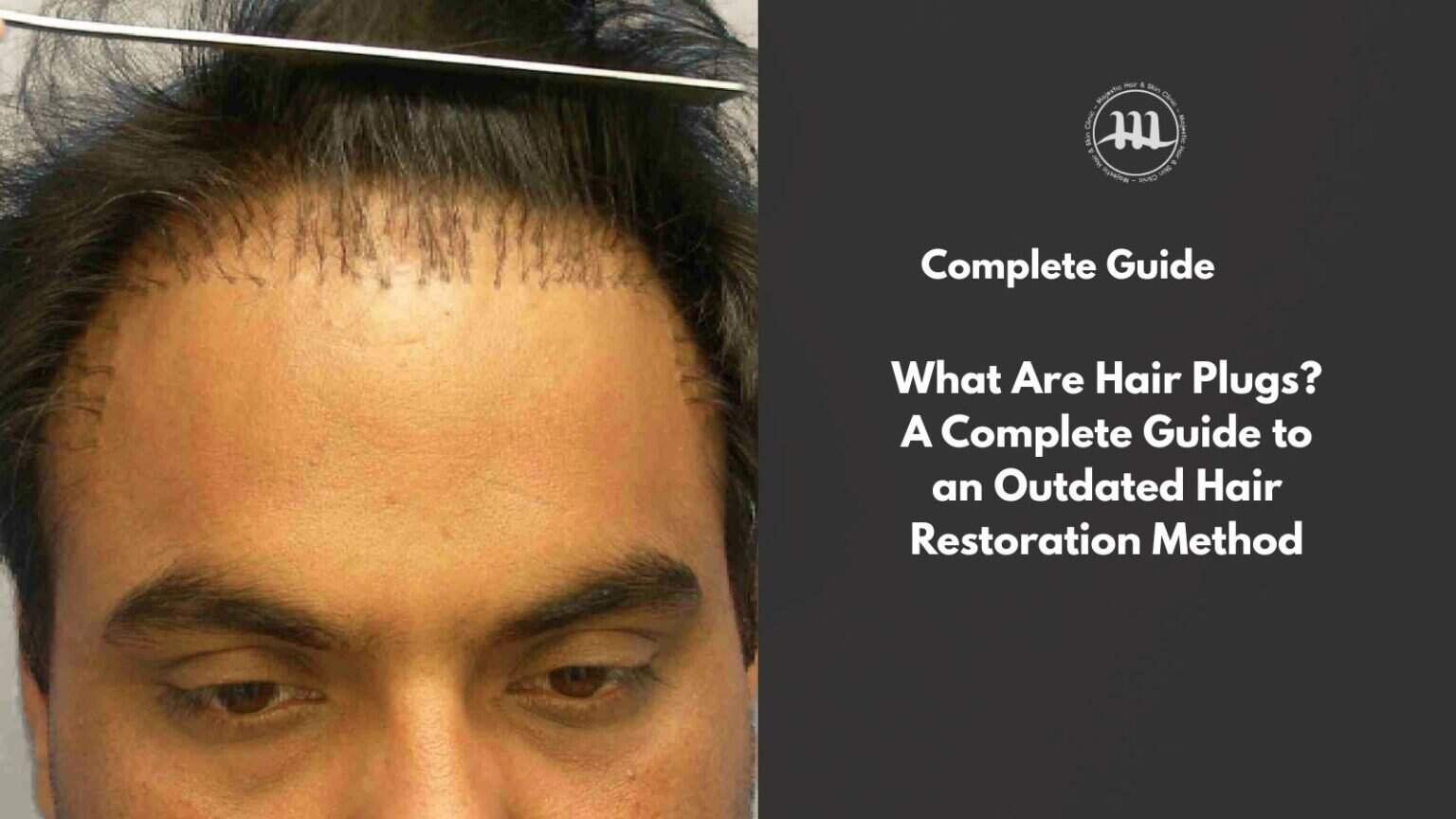 What Are Hair Plugs? Complete Guide & Why They’re Outdated